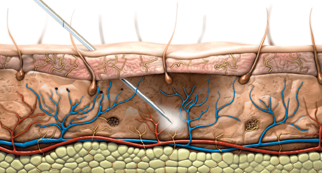 RITUXAN HYCELA® (rituximab/hyaluronidase human) Proposed MOA