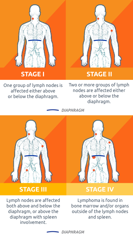 Diffuse Large B-cell Lymphoma Stages | RITUXAN HYCELA
